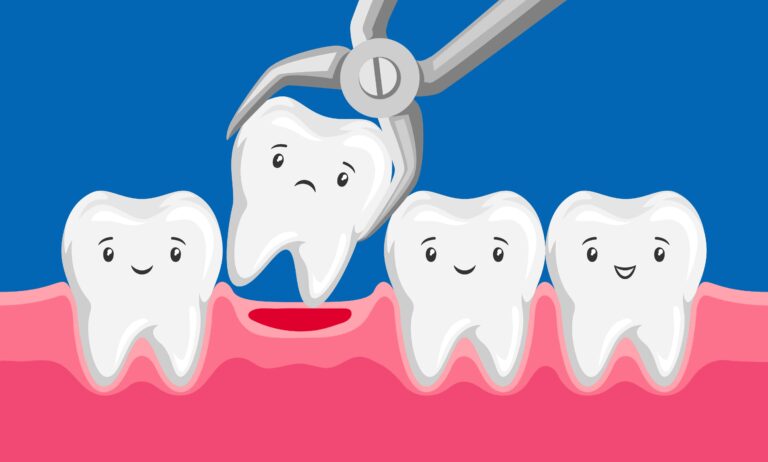 Reasons for Tooth Extractions, Attleboro | Capron Park Dental